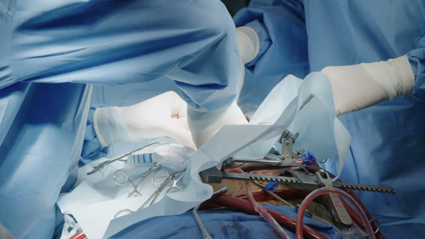 Surgeons Working During Open Heart Stock Footage Video (100% Royalty ...