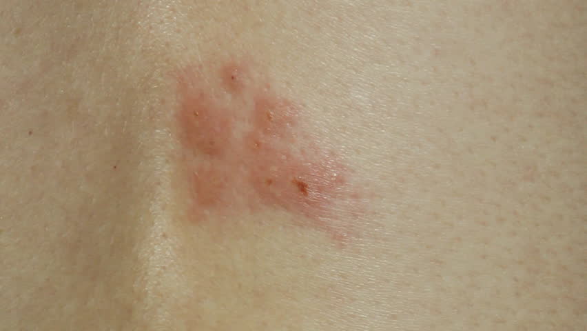 Irritant Contact Dermatitis At Man Leg, Close Up.. Pederus-dermatitis ...