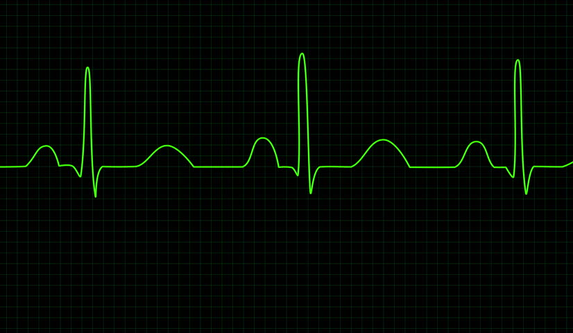 HD Seamless Loop Physiologically Accurate ECG EKG Graph Background ...