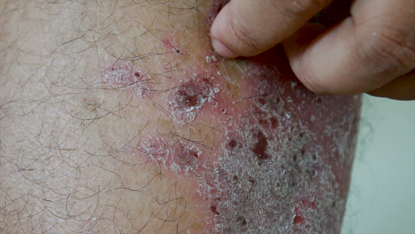 CLOSE UP MACRO: Detail Of Fingertip Scratching Red And Inflamed ...