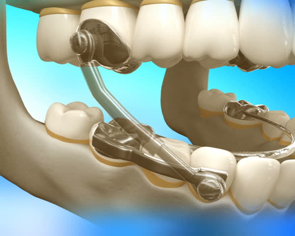 Dental Surgery Animation of Teeth Stock Footage Video (100% Royalty ...