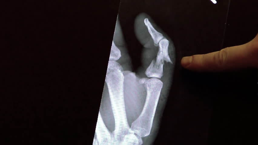 Digital X Ray Of A Badly Broken Crushed Thumb Stock Footage Video ...