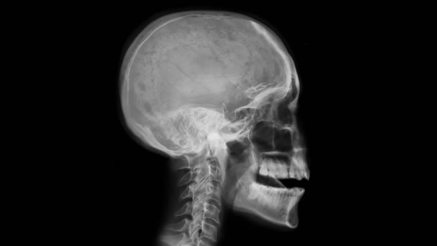 X-ray Of Painful Experimental Procedure On Human Brain. Stock Footage ...